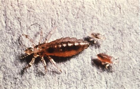 Understanding Lice Types Risks Treatment ETS