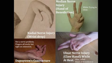 Upper Extremity Injury At Mildred Fulcher Blog