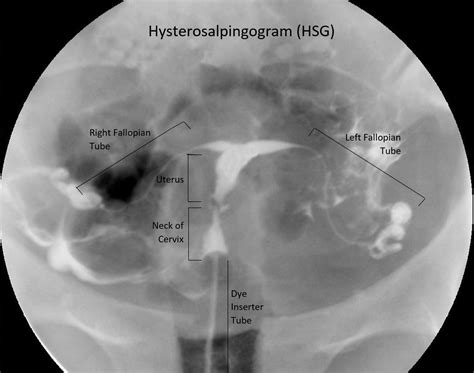 Annotated Hysterosalpingogram Joas Medical Diagnostix