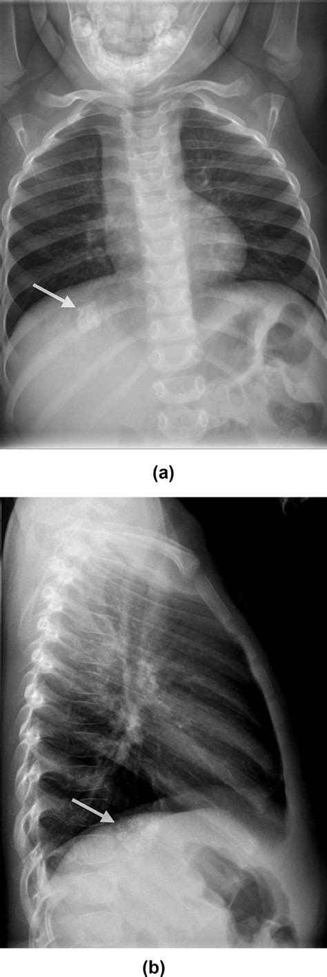 A And B AP And Lateral Chest Radiograph Demonstrating A 1 8 Cm Download Scientific Diagram