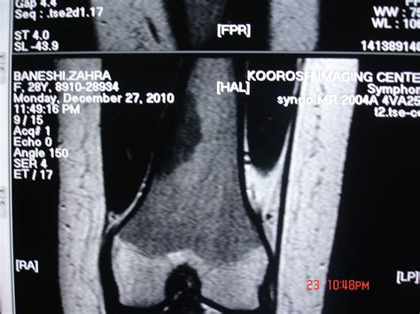Msk Distal Femoral Cortical Defect Or Non Ossifying Fibroma And Proximal Tibial Sclerosis 8