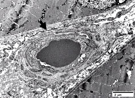 Small Vessel Vasculopathy