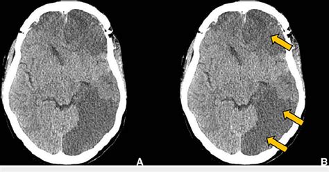 Postoperative Imaging For Patient 2 Non Contrast Enhanced Axial Ct Download Scientific Diagram