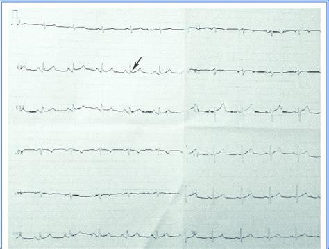 Early Repolarization Pattern Note The Notch With St Segment Elevation
