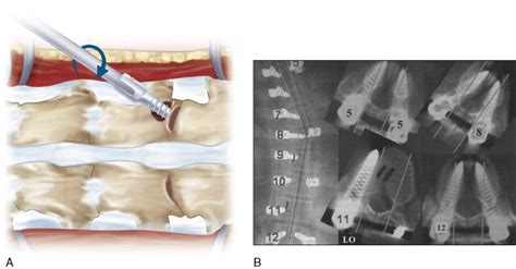 Thoracic Pedicle Screws Neupsy Key