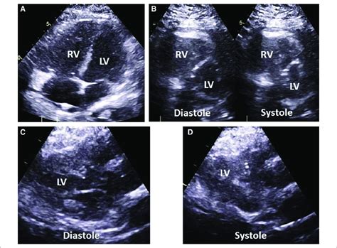 Examples Of Right Ventricular Rv And Left Ventricular Lv Download Scientific Diagram