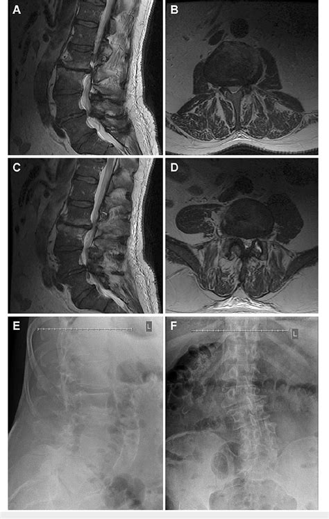 Figure 1 From Pyoderma Gangrenosum Masquerading As Wound Infection In