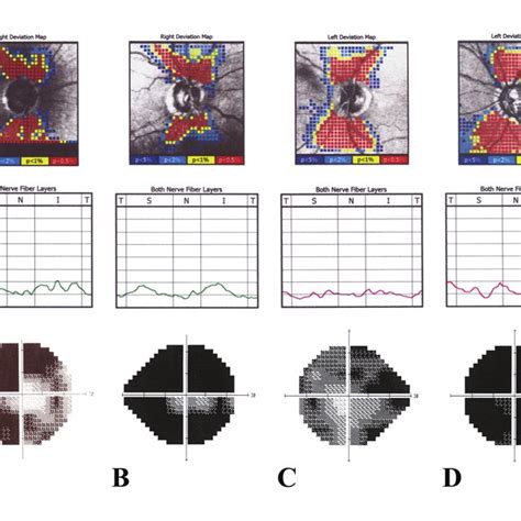 Pdf Correlating Structure With Function In End Stage Glaucoma