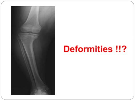 Physiological And Pathological Tibia Vara Ppt Death Injury Or Military Conflict Sensitive