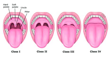 Modified Mallampati Classification 4 Download Scientific Diagram Modified Mallampati Classification 4 Download Scientific Diagram