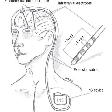Different Varieties Of Dbs Electrode Dbs Deep Brain Stimulation A