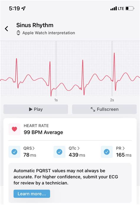 What Causes A Lower Than Normal Qrs For Me It Falls In The Normal
