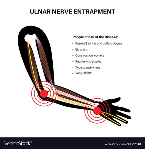 Ulnar Nerve Entrapment Royalty Free Vector Image