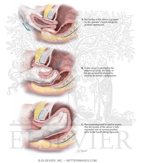 Inversion Of The Uterus