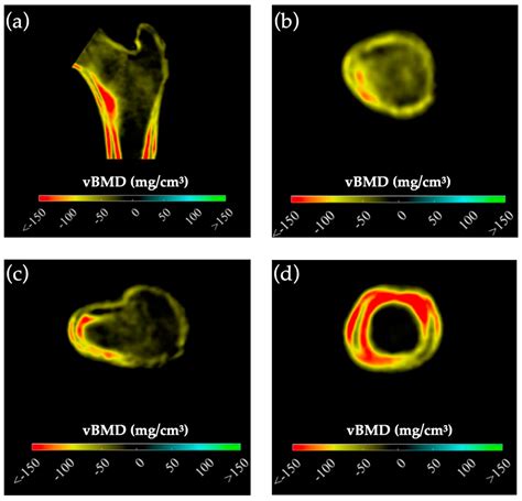 Analysis Of Bone Phenotype Differences In Men1 Related And Sporadic