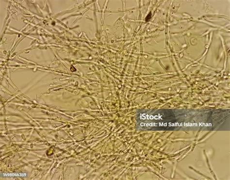 Pseudohyphae และเซลล์ยีสต์รุ่นใหม่ในปัสสาวะของผู้ป่วย วิเคราะห์ด้วยก
