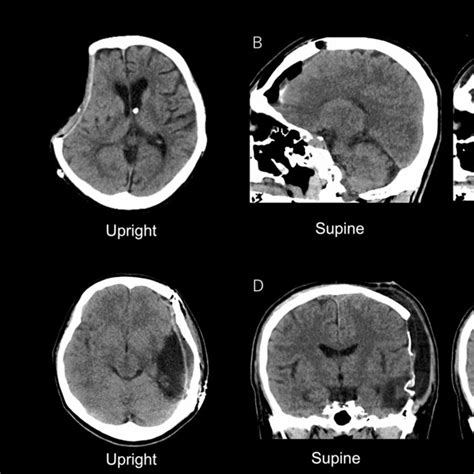 Examples Of Cases With A B And Without C D Positional Brain Shift