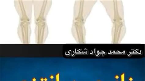 زانوی پرانتزی چیست و درمان آن چگونه است؟ نماشا