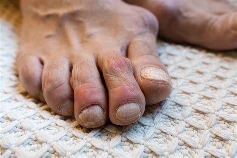 Gout Patients Who Stop Uric Acid Lowering Medication Take More Steroids