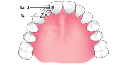 Types Of Retainers In Dentistry Removable Vs Permanent Dentalkart