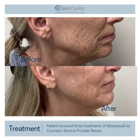 Morpheus8 By Md Skincenter In Rockford