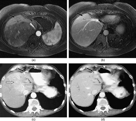 Chemotherapy Induced Sclerosing Cholangitis Clinical Radiology