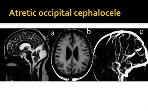Congenital Brain Anomalies Pdf