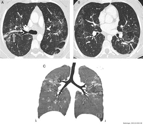 Update Thoracic Sarcoidosis Radiología English Edition