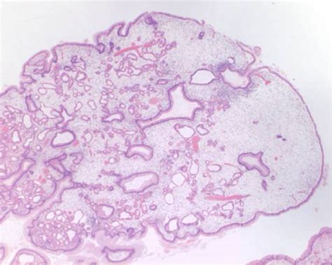 Histology Of Juvenile Polyp Showing Characteristic Features Of Dense