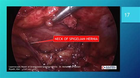 Laparoscopic Repair Of Strangulated Spigelian Hernia Ppt
