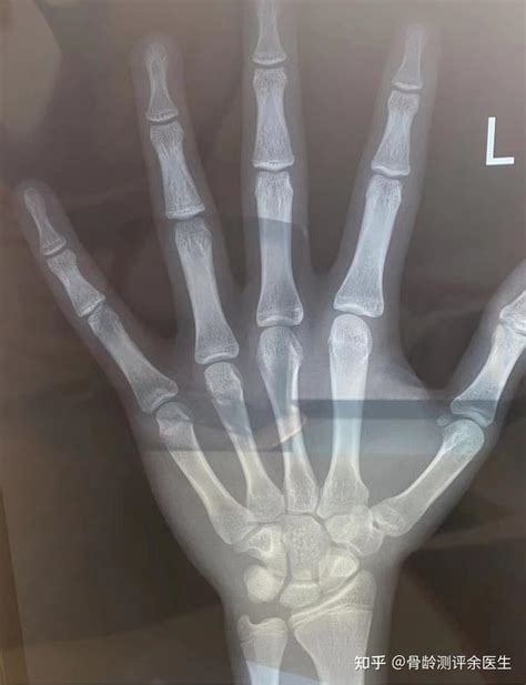 男孩骨龄14 5岁之后干预身高就晚了！ 知乎