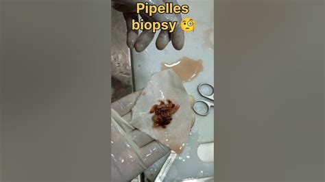 Pipelles Biopsy Sample 🧐 ️ Histopathology Endometrium Biopsy