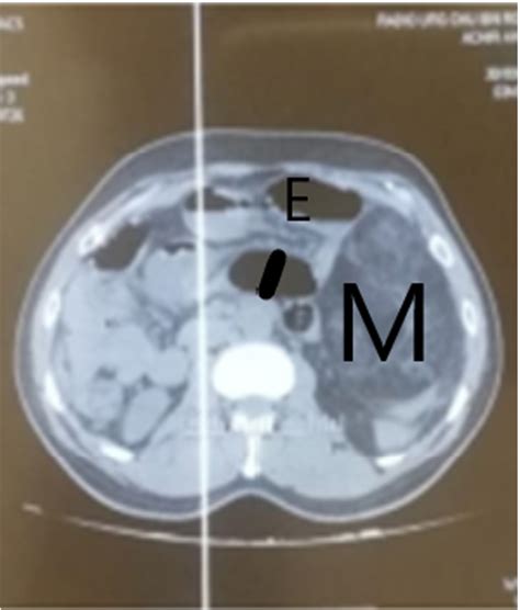 Mesenteric Lipoma With Small Bowel Volvulus A Rare Cause Of Upper