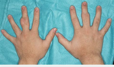 Clinical Findings Soft Tissue Was Swelling Around The Proximal