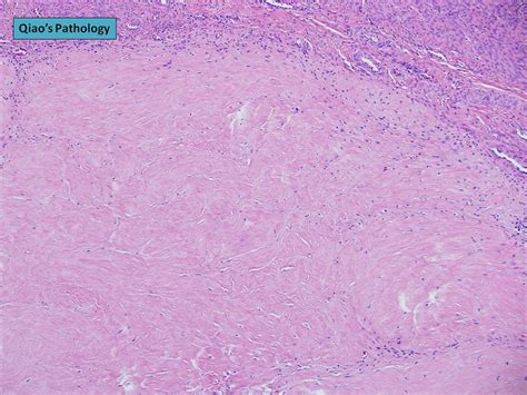 Qiaos Pathology Uterine Artery Embolization Of Leiomyoma Flickr