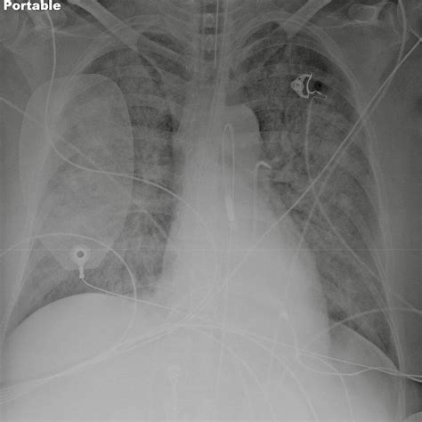 Pneumothorax By Alexander Baxter Radnotes