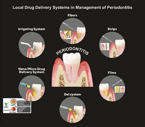 Local Delivery And Controlled Release Drug Systems In Periodontal Diseases