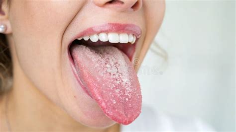 Tongue With White Coating Oral Thrush Or Candidiasis Stock