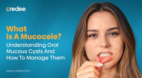 Mucocele Causes Symptoms Treatment And Payment Solutions