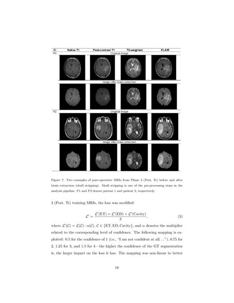 Deep Learning Automates Bidimensional And Volumetric Tumor Burden Measurement From Mri In Pre