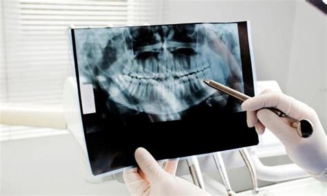 Mengenal Apa Itu Rontgen Gigi Beserta Jenis Dan Manfaatnya Dokter Gigi Palembang Profesional