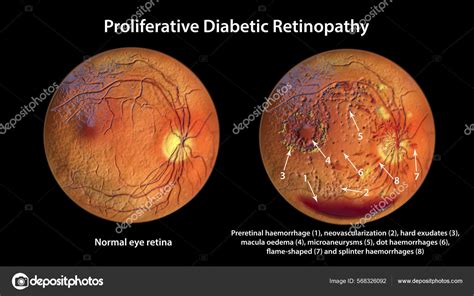 Proliferative Diabetic Retinopathy Illustration Shows Preretinal