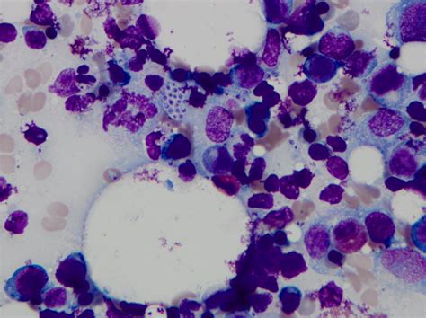 Wright‐giemsa Stain Of The Bone Marrow Biopsy Specimen Showing