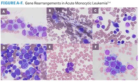 Defining Advances In The Who Classification For Aml