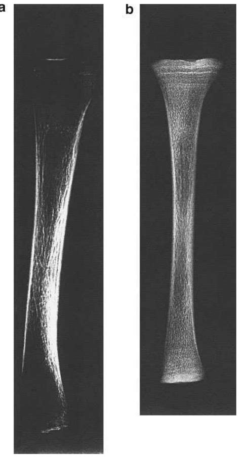 A Anterio Posterior Radiograph Tibia Burial Hb402 Note