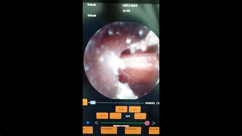 Michal Matias On Linkedin Deep Gluteal Syndrome Sciatic Nerve Release Hydrodissection By 7ss