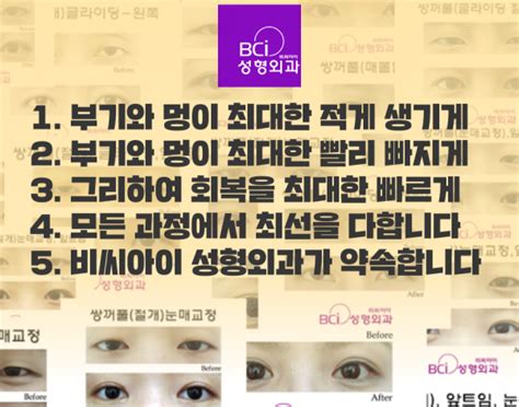 쌍꺼풀 매몰법 수술 후 시간에 따른 붓기 변화 중년눈성형 잘하는 비씨아이 눈매교정 눈성형의 모든것 비씨아이 성형외과