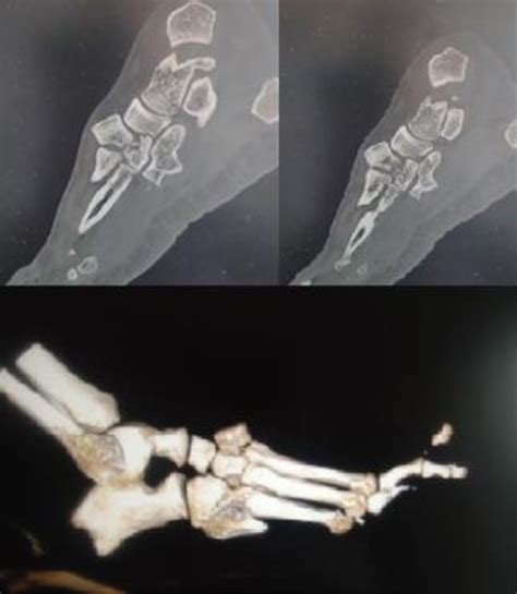 Ct Scan Images Demonstrating The Non Displaced Lateral Cuneiform Download Scientific Diagram