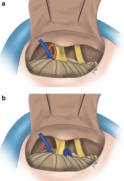 Illustration Depicting An Arterial Compression Of The Trigeminal Nerve