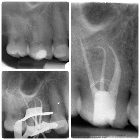 Root Canal Treatment Belfast Endodontics